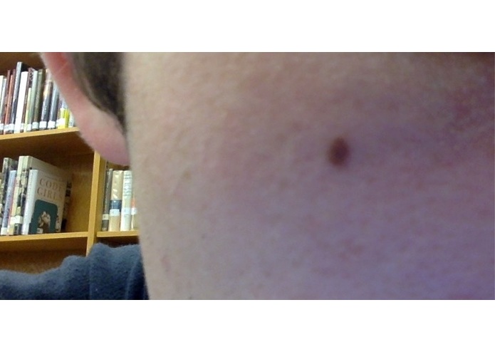 Skin Cancer/Melanoma Detector | Devpost