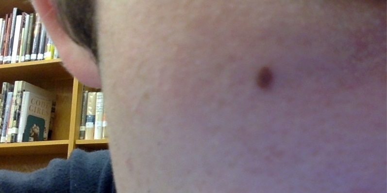 Skin Cancer/Melanoma Detector | Devpost