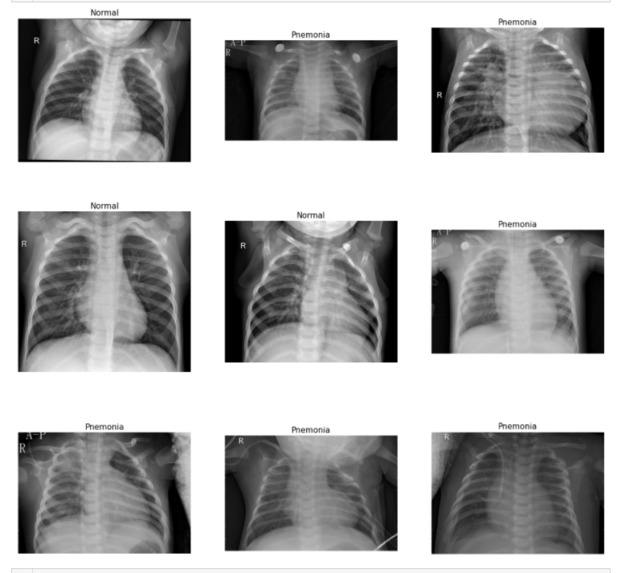 Predicting pneumonia from chest x-ray images | Devpost