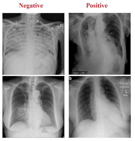 DTL-COVID: COVID-19 Prediction from Chest X-ray | Devpost