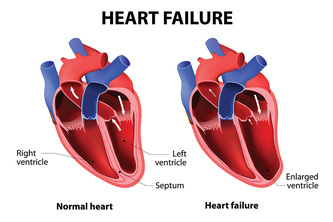 Binary Classification of Heart Failure using FOLD-R++ | Devpost