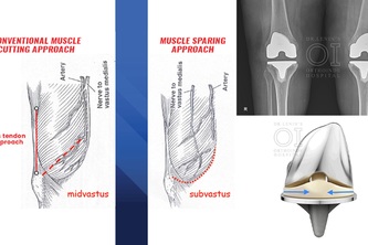 Knee Replacement Surgery in Chennai | Devpost