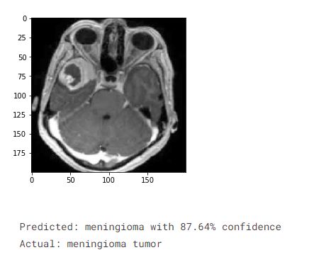 Brain MRI tumor classification | Devpost