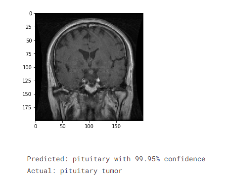 Brain MRI tumor classification | Devpost