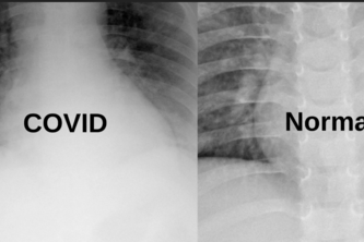 Corona hack chest X-ray | Devpost
