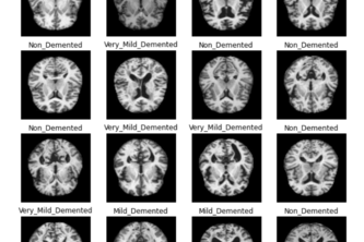 Alzheimer's Detection using ML | Devpost