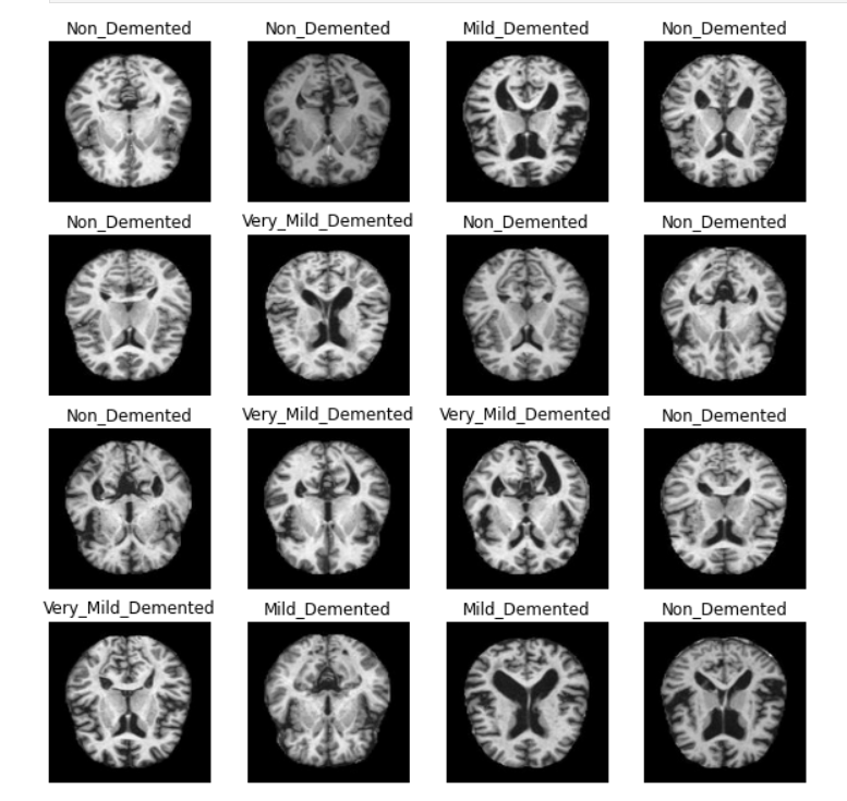 Alzheimer's Detection using ML | Devpost Alzheimer's Detection using ML | Devpost