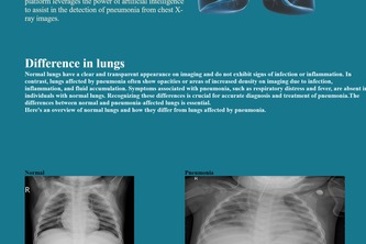 Pneumonia Detection | Devpost