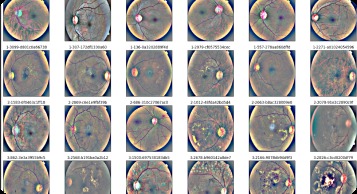 EyeSnap : Diabetic Retinopathy Detection with DiaScan | Devpost