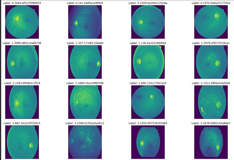 EyeSnap : Diabetic Retinopathy Detection with DiaScan | Devpost