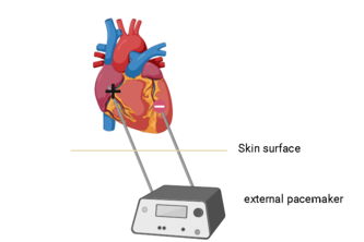 Bipolar Pacemaker | Devpost