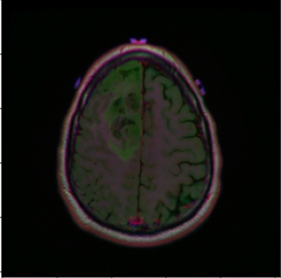 NeuroVisionAI: TumorMapperNet | Devpost