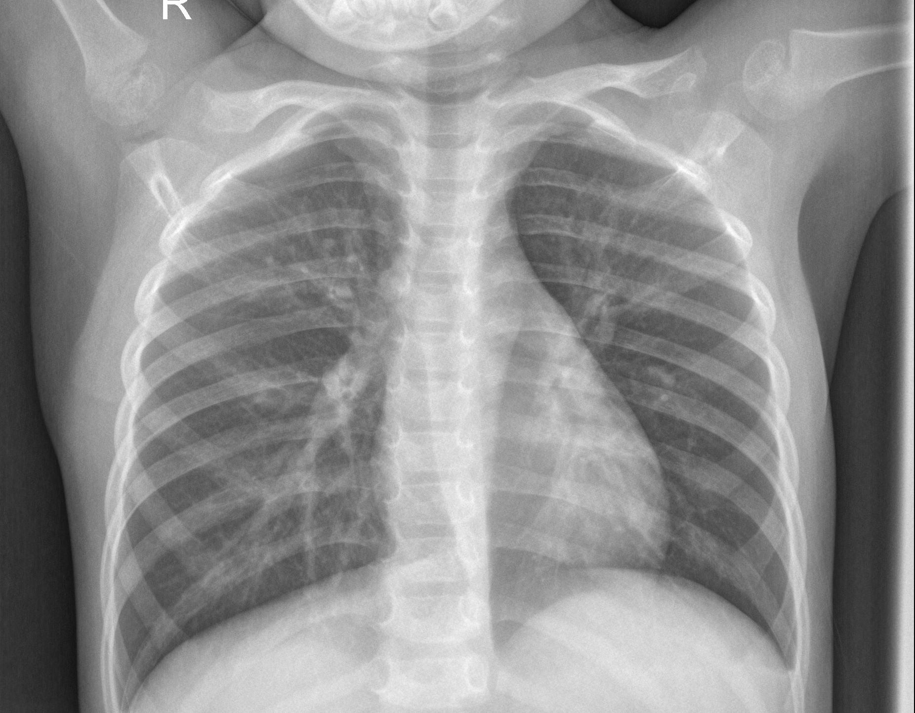 CLOUD APP FOR PNEUMONIA DETECTION GIVEN X-RAY IMAGES IN DL | Devpost