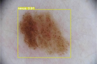 AI: Skin Cancer Detection for Early Intervention | Devpost