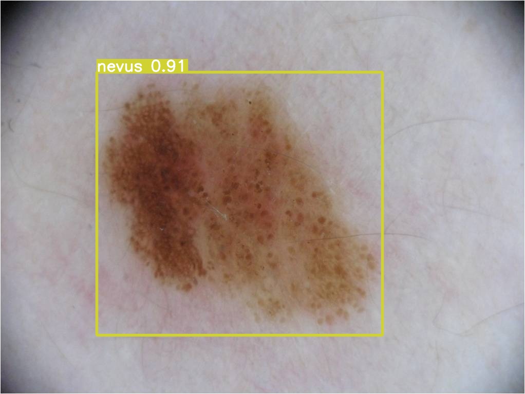 AI: Skin Cancer Detection for Early Intervention | Devpost