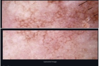 DermAi: AI-Powered Skin Disease Detection | Devpost