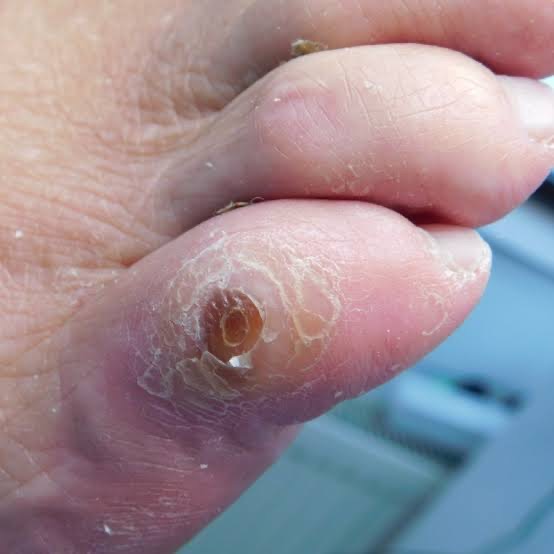 Salvage Diabetic limbs | Devpost