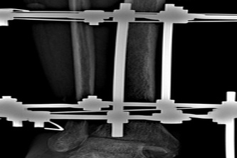 OsteNet: A Novel Tool For Hairline Fractures In Bone Disease | Devpost