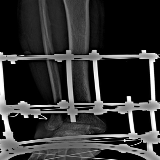 OsteNet: A Novel Tool For Hairline Fractures In Bone Disease | Devpost