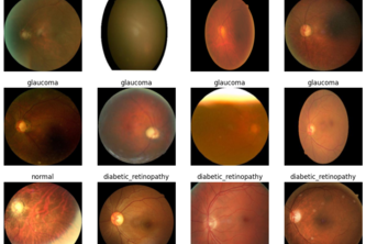 Eye Disease Detection Model | Devpost
