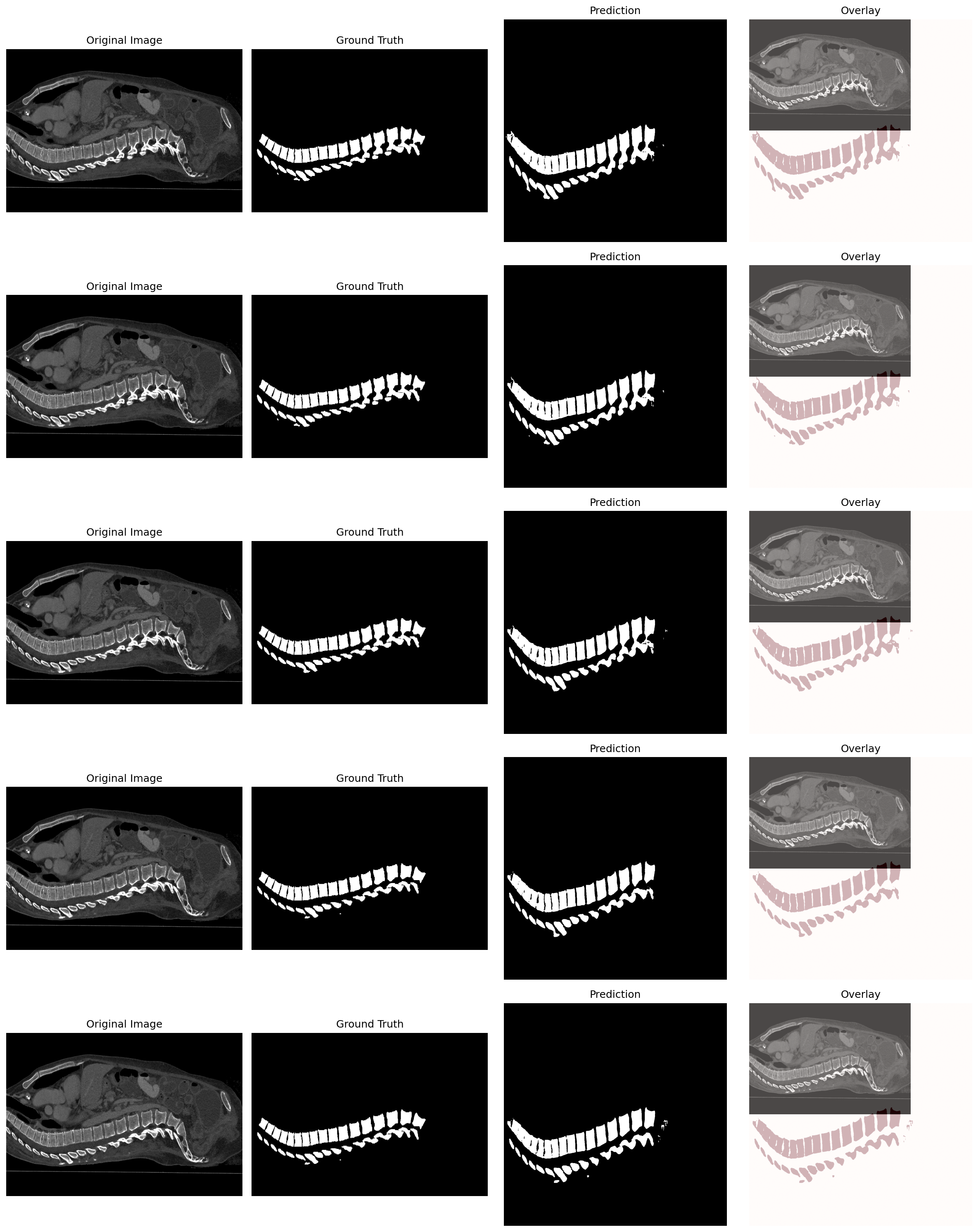 2-D Spinal Segmentation & Fracture Detection | Devpost