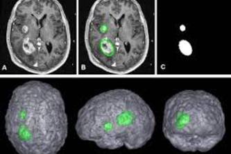 Brain Tumor MRI Image Segmentation And Detection | Devpost