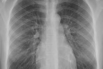 Pneumonia-detection-using-CNN | Devpost