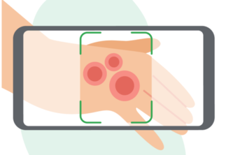 Skin-Cancer Detector | Devpost