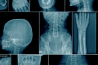 Chest X-Ray Disease Classification | Devpost
