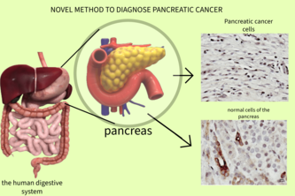 Prognosing Pancreatic Cancer | Devpost