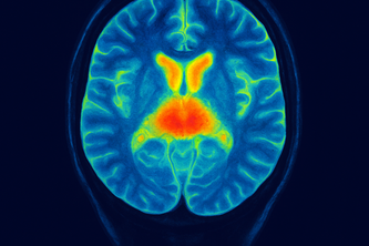 Alzheimer’s MRI Detection | Devpost
